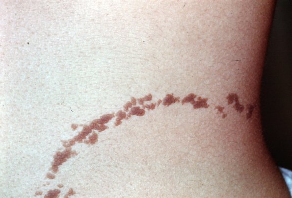 PICT0004 | Epidermal nevi | Dr. Ken Hashimoto | Wayne State University SOM - Dermatology Image ...
